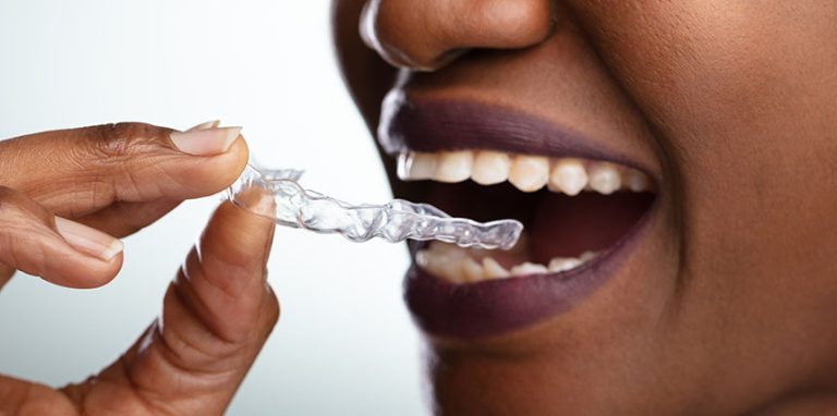 Removable Braces – Dentist in Athlone and Woodstock